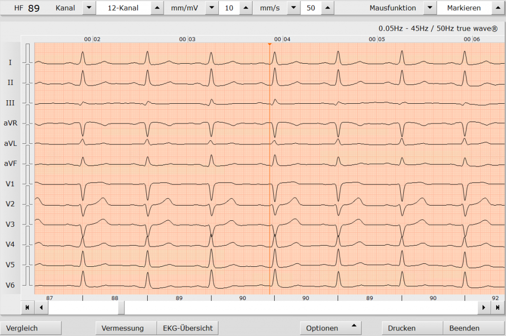 EKG – Kardiologische Praxis Lippstadt EKG – Kardiologische Praxis Lippstadt